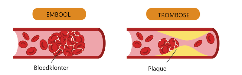 Vasculaire Praktijk: Acute verstopping van beenslagaders